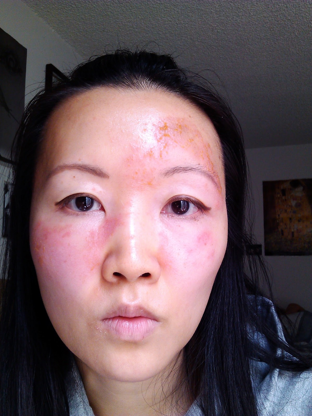 My Staph Story: My Staph Story