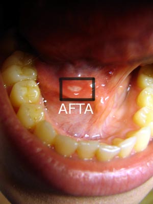 CASOS ODONTOLÓGICOS: ENFERMEDADES DE LA BOCA: ENFERMEDAD DE CROHN: AFTA