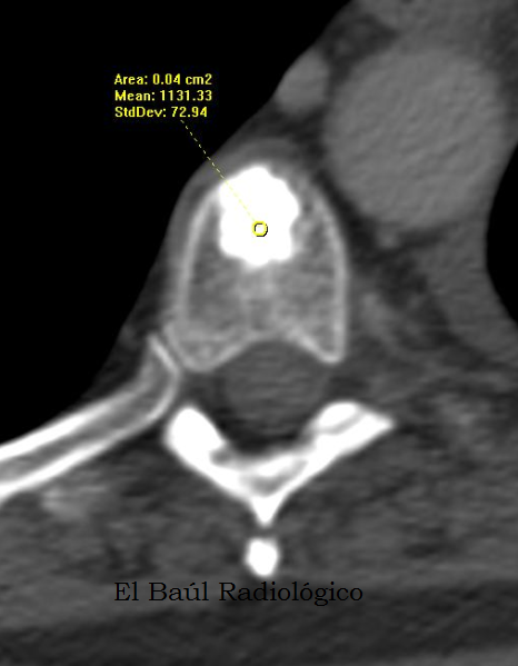 El Baúl Radiológico: ENOSTOSIS: ISLOTE ÓSEO (Bone Island: CT and MRI ...