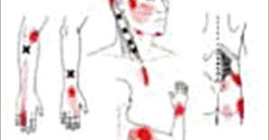 Travell and simons trigger point referral patterns adductor - frontvsera