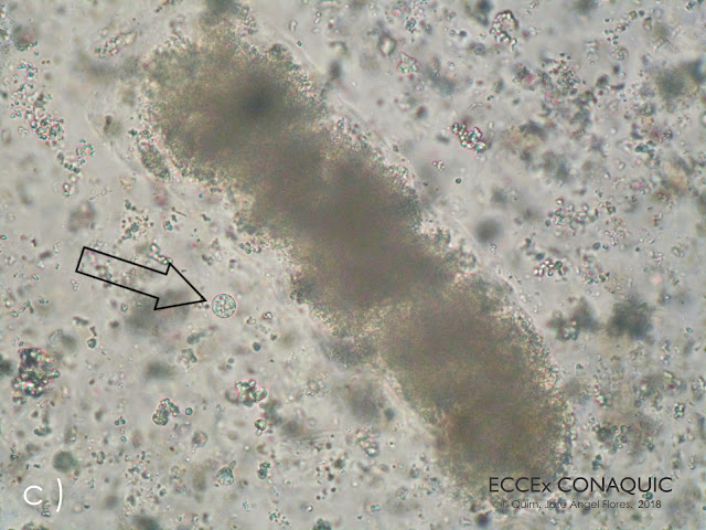 Caso UR-mayo-18 (Enfoque: cristaluria)