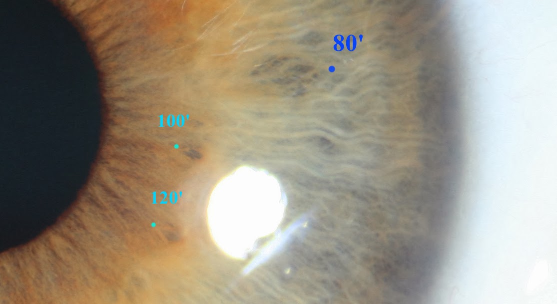 Modern & Multidimensional Iridology: Orange Central Heterochromia, Iris ...