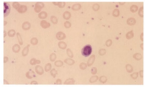 FICHERO HEMATOLOGIA : Microcitos
