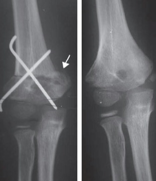 DR. CELSO RIZZI: Cubito Varo - Sequela da Fratura do Cotovelo na Criança
