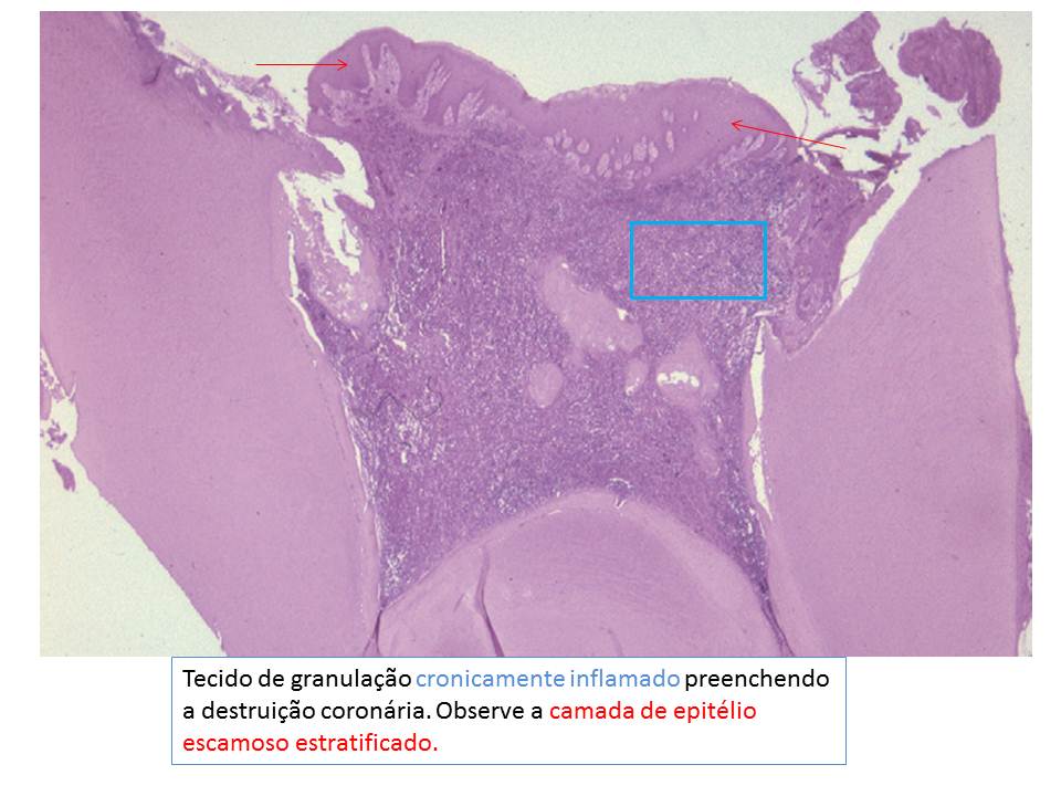 Patologia Oral : Pulpite Crônica Hiperplasica