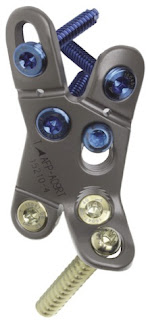 The Daily Fix: New Ascension Ankle Fusion Plate