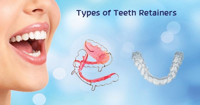 Various Types of Teeth Retainers Available Online & Their Usage ...