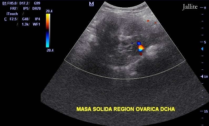 Miomatosis Uterina