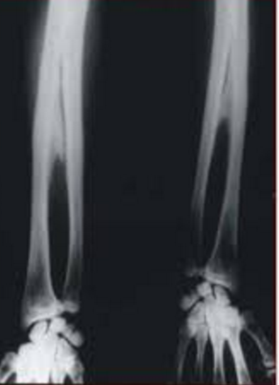 Flourosis: Xray - Sumer's Radiology Blog