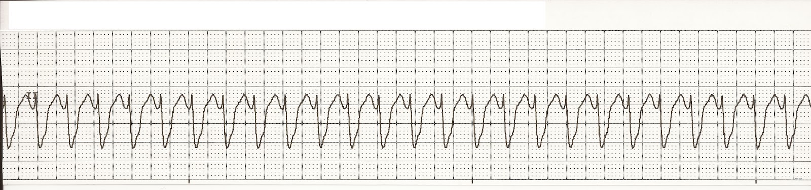 ACLS review: Wide Complex Tachycardia (WCT) Part 1