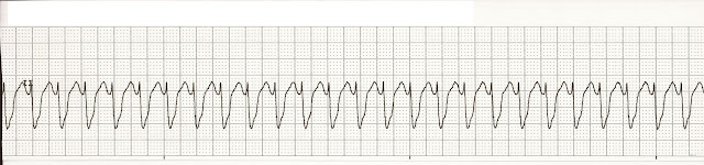 ACLS review: Wide Complex Tachycardia (WCT) Part 1