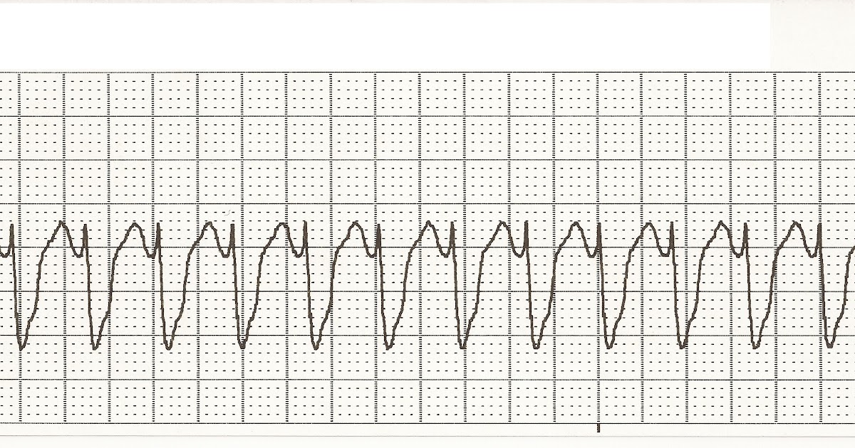 ACLS review: Wide Complex Tachycardia (WCT) Part 1