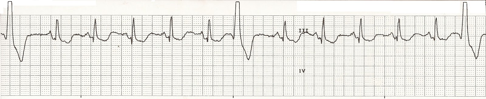 EKG Rhythm Strip Quiz 47
