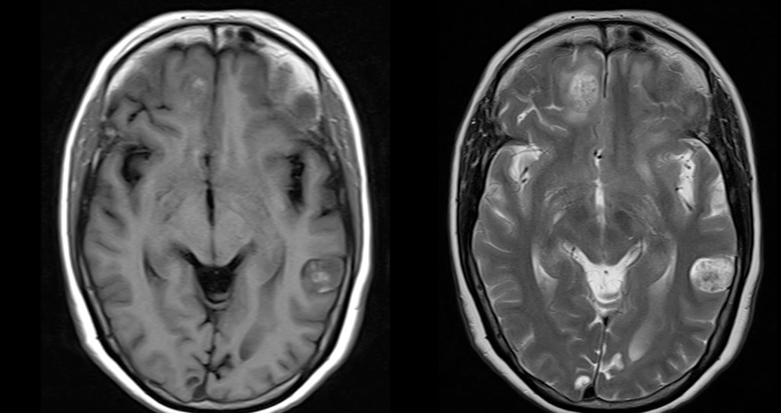 Ultimate Radiology : Hemorrhagic dural and parenchymal metastases : BRAIN