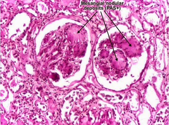 PATOLOGÍA HUMANA: EL RIÑÓN COMO DIANA PRINCIPAL DE LA DIABETES MELLITUS