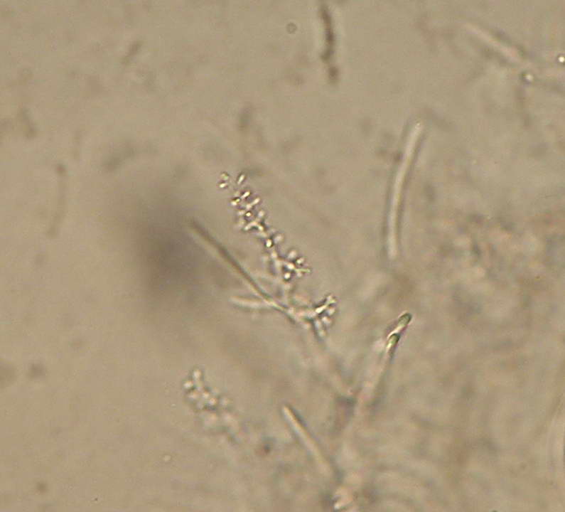 ATLAS MICOLOGIA: SICOSE POR TRICHOPHYTON MENTAGROPHYTES