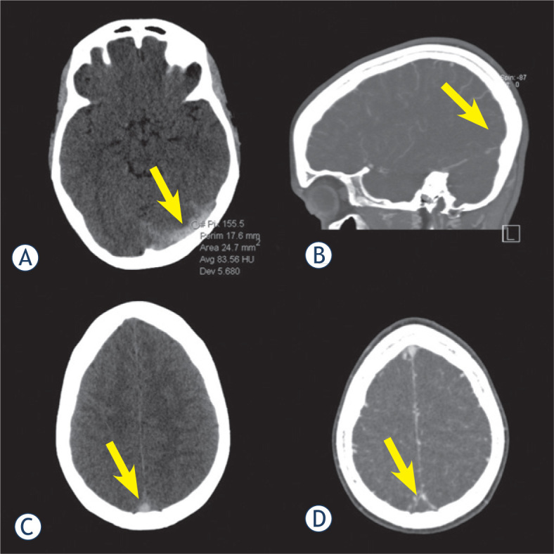 MRI Differential Diagnosis: Dense Venous Sinus.
