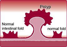 COCHIN CARDIAC CLUB: POLYPS OF COLON