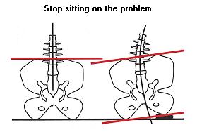 Physioguru: Wallet sciatica