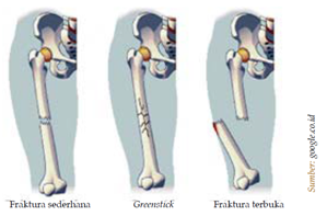 Kelainan Pada Tulang