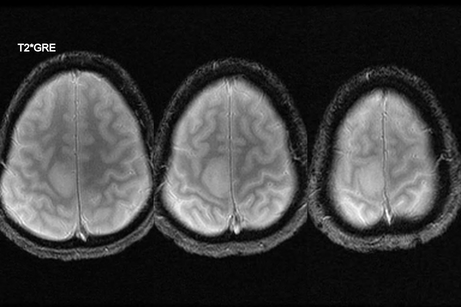 Dr Balaji Anvekar FRCR: Parietal lobe lesion on MRI