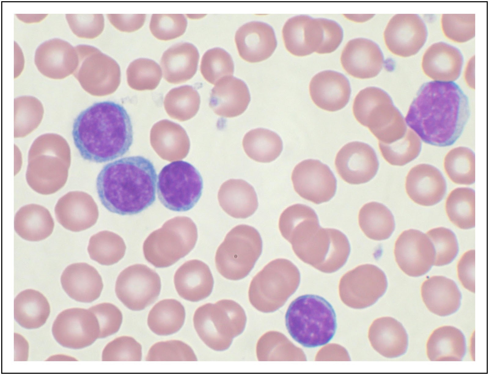 7 Tanda Terkena Kanker Leukemia Akut | Tips Kesehatan Reproduksi