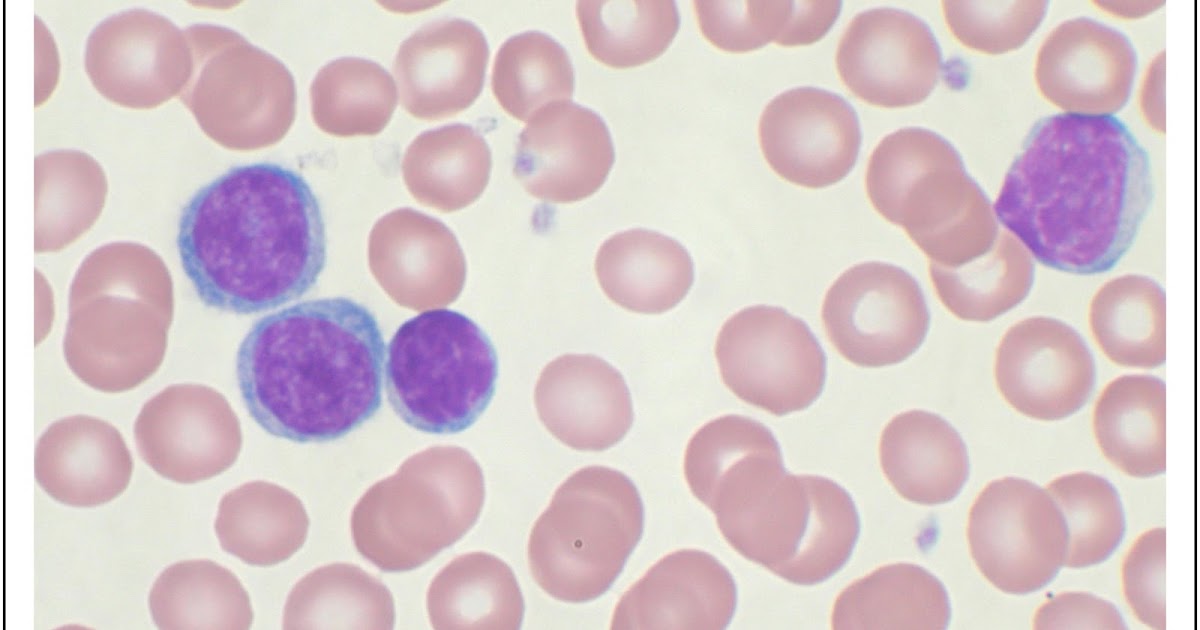 7 Tanda Terkena Kanker Leukemia Akut - Obat Sakit 2011