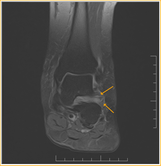 Sinus Tarsi Syndrome : MRI - Sumer's Radiology Blog