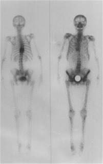 Modulo Intensivo de Imágenes Medicas 2: gammagrafia osea