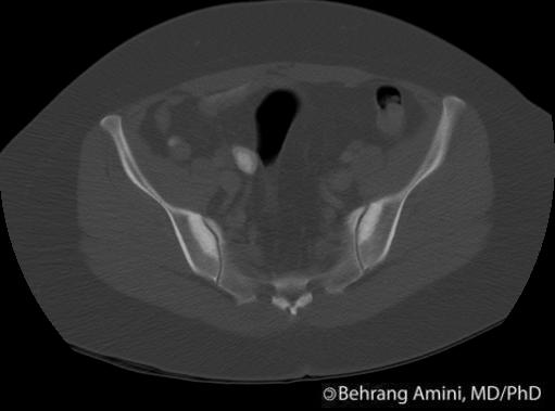 Roentgen Ray Reader: Osteitis Condensans Ilii