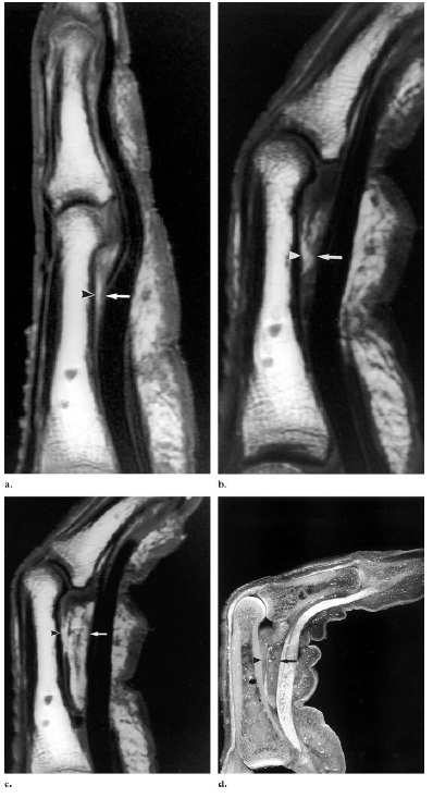Tom's Physiotherapy Blog: Pulley Injuries: updated