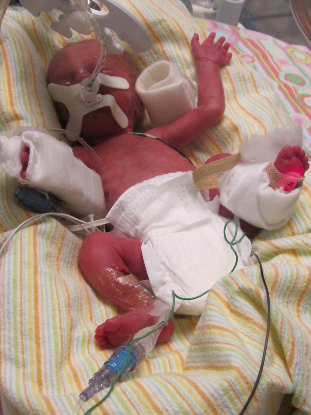 Feeding Olive: Encouragement Feeding Program