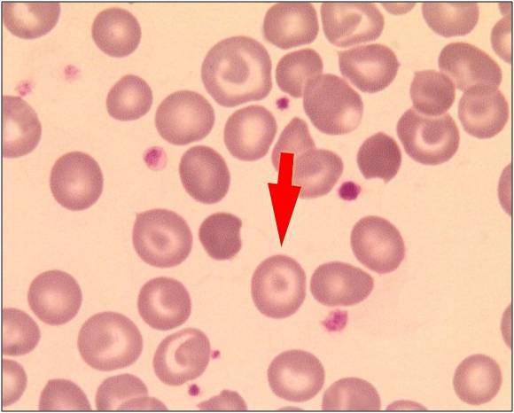 silviaquerida: Kelainan Sediaan Apus Darah