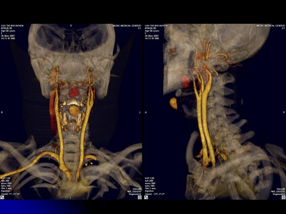Pathology Outlines - Lingual thyroid