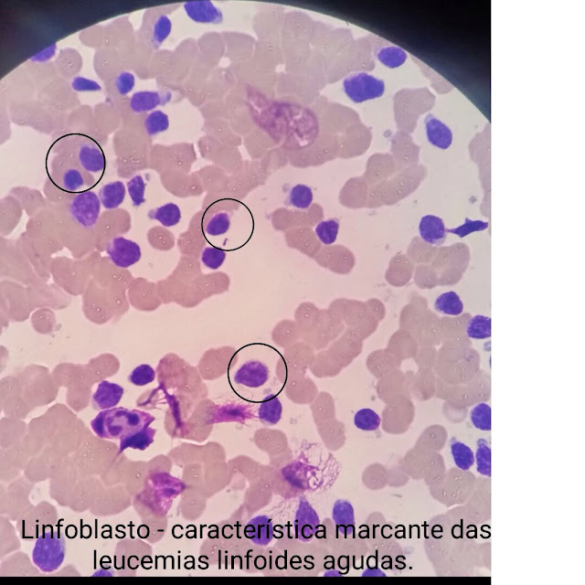 HISTOLOGIA90: MORFOLOGIA DAS CÉLULAS DO SANGUE E LEUCEMIAS