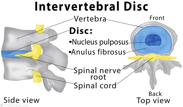 .: Cara Mengurangkan Sakit Slipped Disc