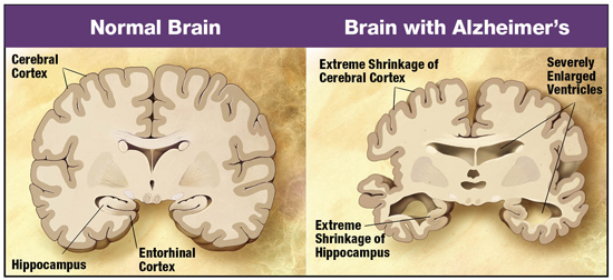 VIVA JOY HEALTH: Who am I ? - Alzhemier's