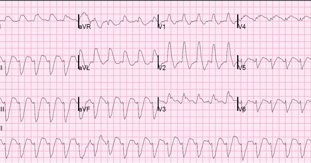 Dr. Smith's ECG Blog: Wide Complex Tachycardia; It's really sinus, RBBB ...