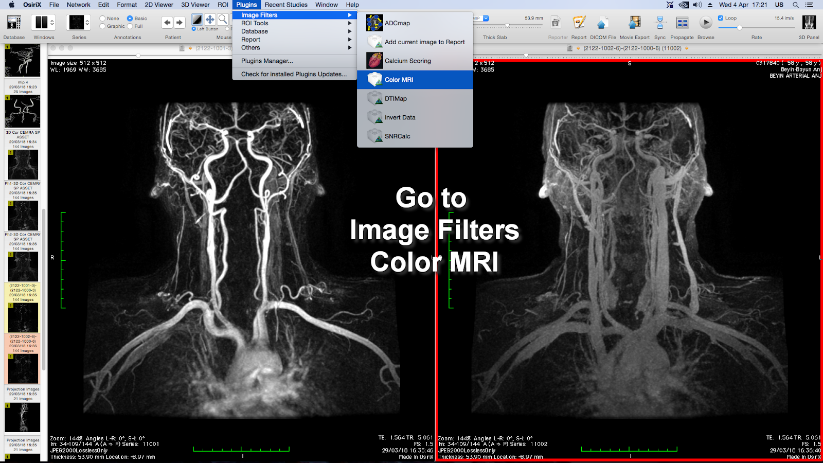 Nevit's blog: How to Create Color MR Angiography using Osirix and Color ...
