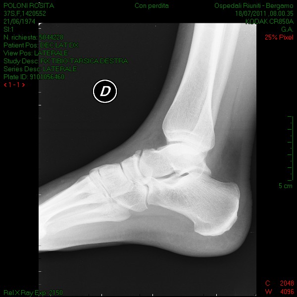 trentagiorni: 28. scafoide tarsale . tarsal scaphoid