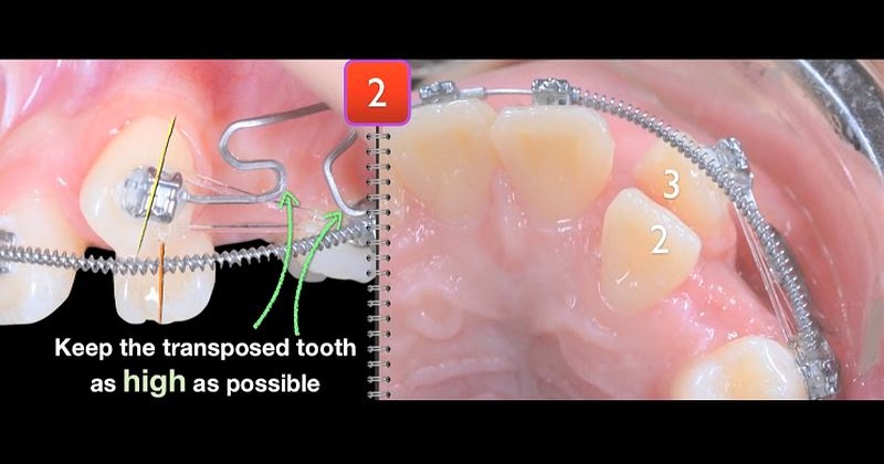 ORTHODONTICS: Treatment for Transposed Cuspid - Odonto-Tv