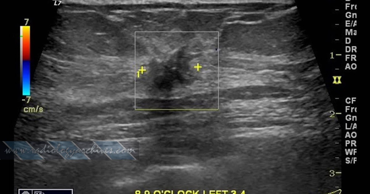Radiology Archives: Βλάβη Μαστού BI-RADS 5