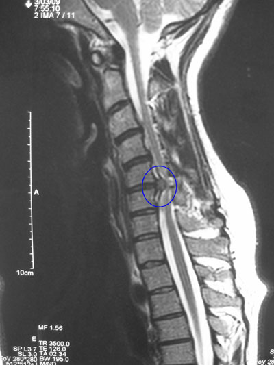 SAÚDE: HÉRNIA DISCAL CERVICAL ~ Um Olhar Povoacense