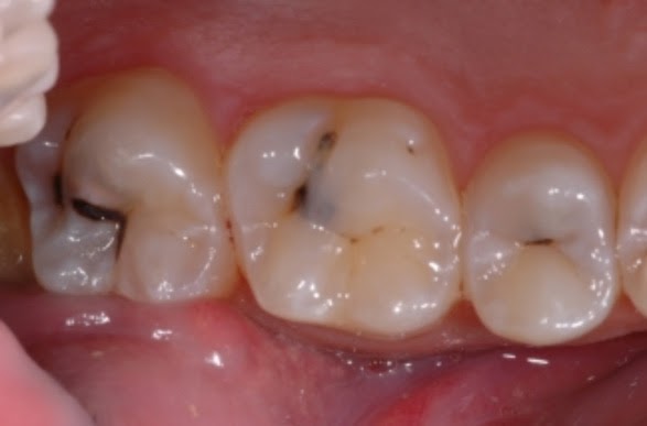 Dental Mnemonics: Pit And Fissure Caries