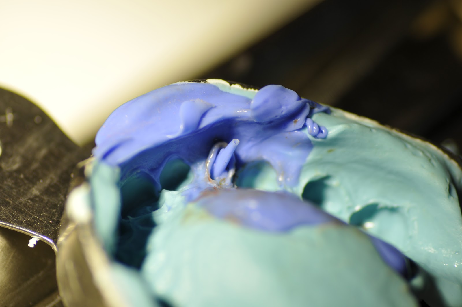 Empreintes TFM: Tenon faux moignon IC: Inlay core ACR: Ancrage corono ...