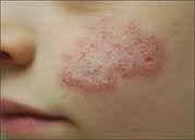 impetigo home remedies: How To Get Rid of Impetigo Scars Quickly