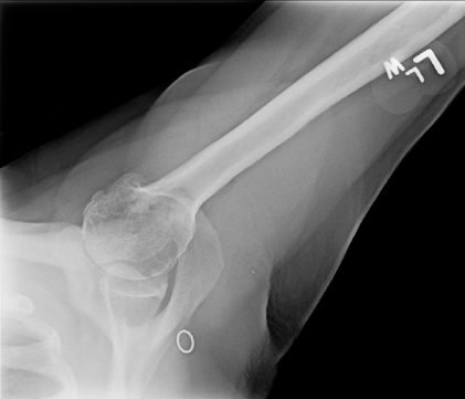 Shoulder and Elbow Surgery: Reverse shoulder replacement for severe ...