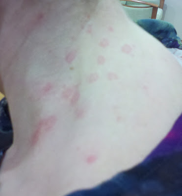 Stress Rash Free Pictures | TOP Video