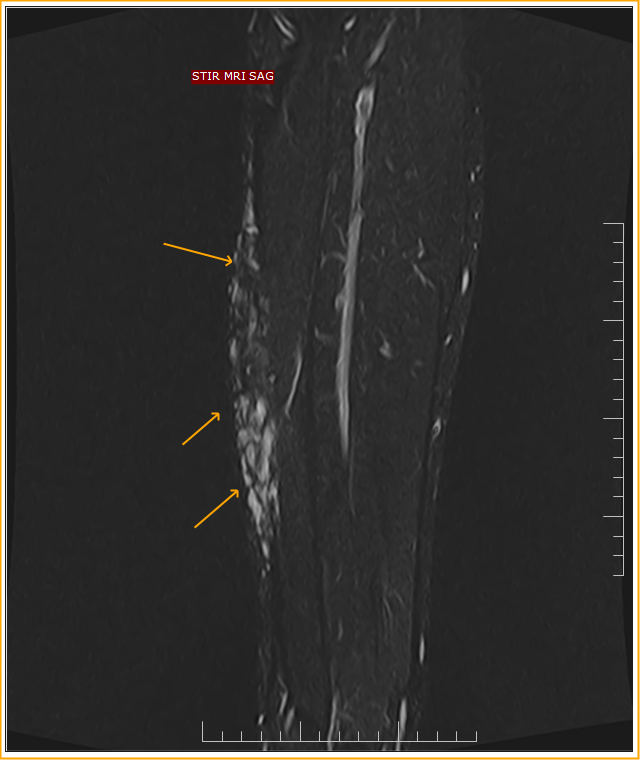 Adamantinoma Tibia -Cross sectional Imaging - Radiology Imaging