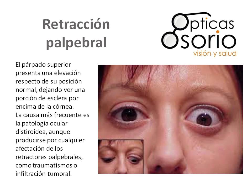 Ópticas Osorio : Retracción Palpebral